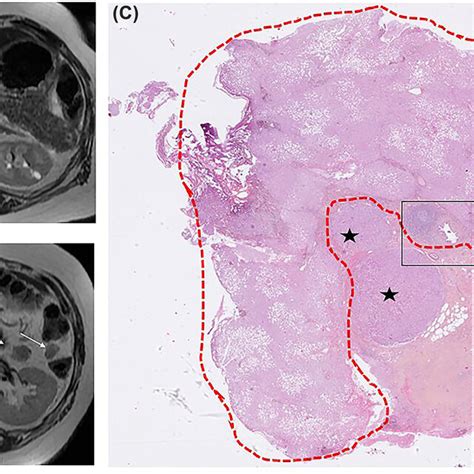 Magnetic Resonance Imaging Mri Of The Liver And Peritoneum Axial T2