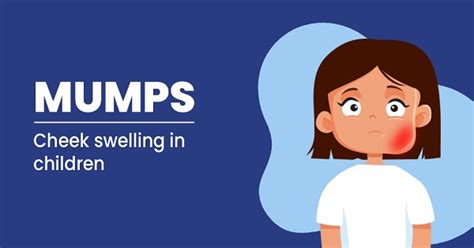 When Mumps Outbreak Hit Schools Graphic Online