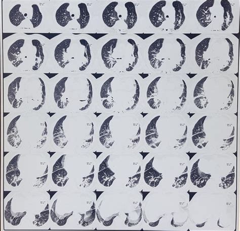 The Multidetector Computed Tomography Scan Of Chest Showing Patchy