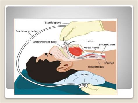 Suctioning Procedure Pptpptx