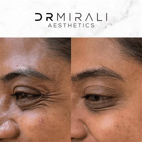 Crows Feet Treatment In South London Dr Mirali Aesthetics