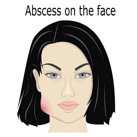 Skin Abscess Illustrations Royalty Free Vector Graphics And Clip Art