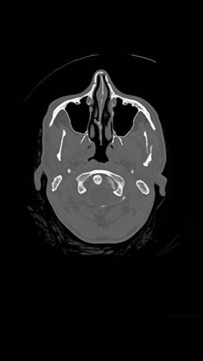 Displacedand Medially Angulated Fracture Through The Neck Of The Left Condylar Process Of The