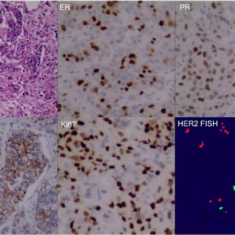 Surgical Pathology Of The Brain Metastatic Lesion Hematoxylin Eosin