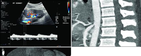 Initial Imaging Work Ups A Duplex Ultrasonography Revealed The