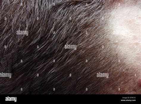 Human Alopecia Or Hair Loss Disease Dermatology Stock Photo Alamy