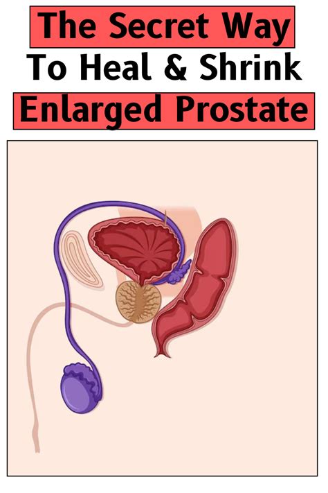 Understanding Prostate Health Disease A Complete Guide Artofit