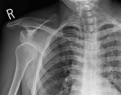 Anterior Vs Posterior Shoulder Dislocation Xr