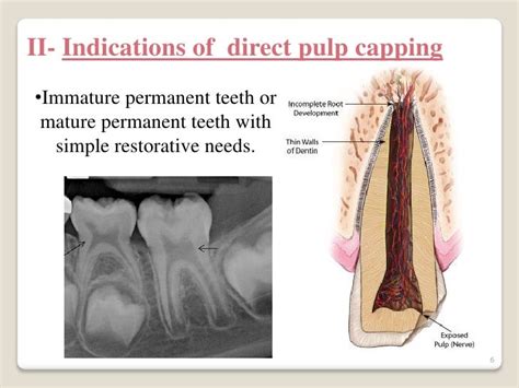 Direct Pulp Capping