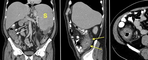 Typhlitis Radiology At St Vincents University Hospital