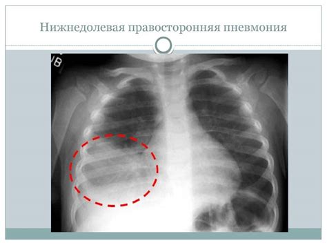 Пневмония На Рентгене Легких У Взрослых Фото — Картинки фотографии