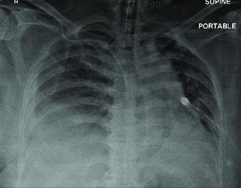 Chest X Ray Showing Bilateral Patchy Opacities And Bilateral Pleural