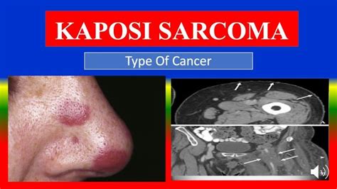 Kaposi Sarcoma Definition Types Causes Pathophysiology Symptoms… Prof M Thanga Darwin