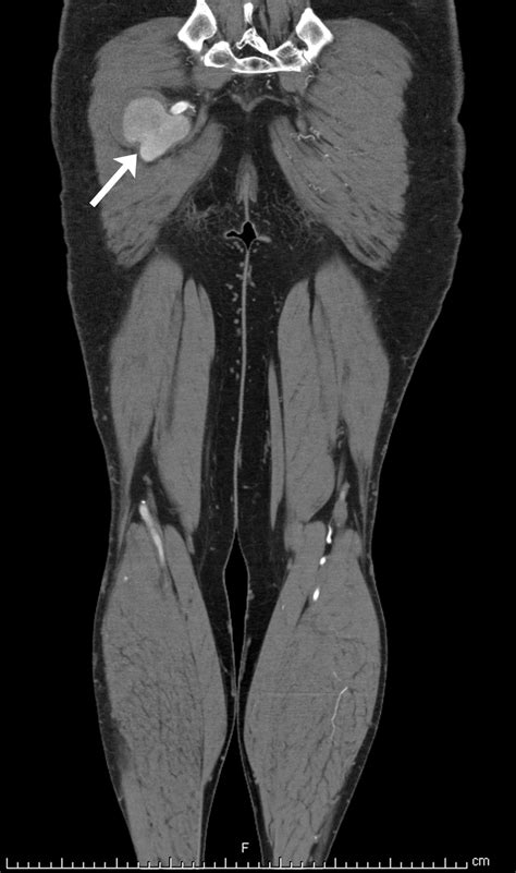 Computed Tomography Angiogram Of Lower Extremities Highlighting Extent