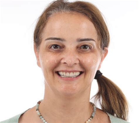 Facetas dentárias Caso 35 Clínica Clínica Dentária Cerejeira e Leão