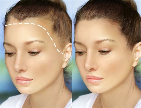 Frontal Fibrosing Alopecia Symptoms Causes And Treatment
