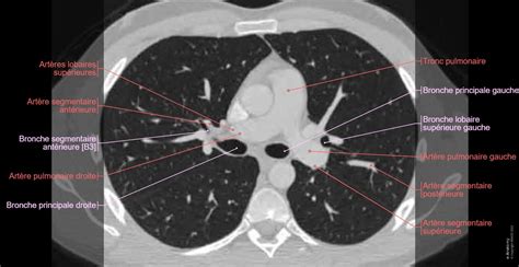 Anatomie Des Poumons Du Médiastin Et Du Cœur En Tdm Axiale E Anatomy