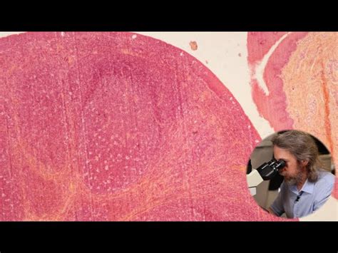 Free Video Histology Of The Tonsil Understanding Tonsillitis Through
