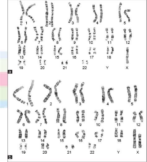 Isochromosome X I8q10 In All