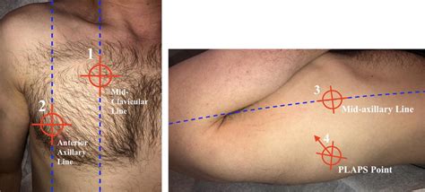Anterior Axillary Line