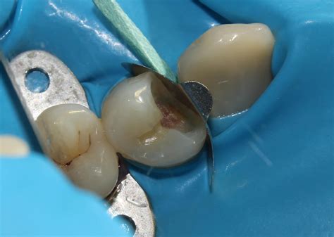 Deep Class 2 Caries Management Myzerodonto