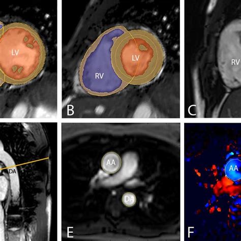 MR Images Demonstrating The Assessment Of Biventricular Volumes And