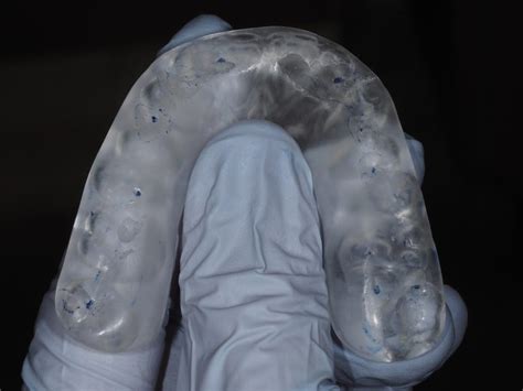 Tips For Issuing Occlusal Splints Dental Head Start