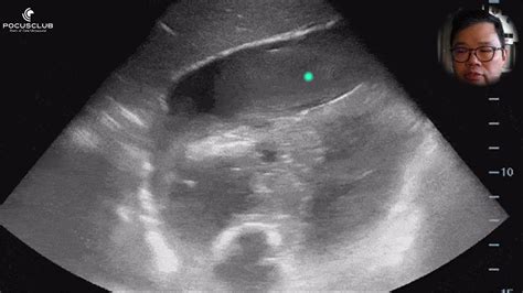 Efast Or Efail How To Do The Efast Pocus Exam Youtube