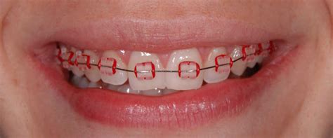 Red Braces A Comprehensive Guide To Stylish And Effective Orthodontic