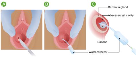 Me Sale Una Masa Blanca En La Vulva On Sale Cdlguaiba Br