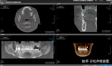 当天种牙，当天吃肉！「即刻负重」种植技术真这么神奇？ 知乎