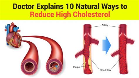 A Doctor Explains 10 Natural Ways To Reduce High Cholesterol