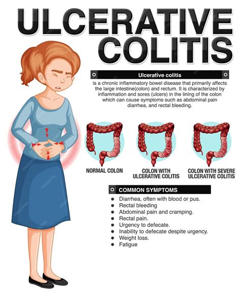 Infografía De Los Síntomas De La Colitis Ulcerosa Vector Gratis