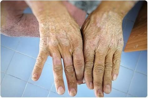 Causes Of Scleroderma Medizzy