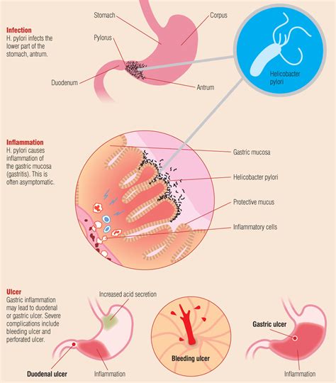Helicobacter Pylori Infection Inflammation Ulcer Diagram Exeter Gut
