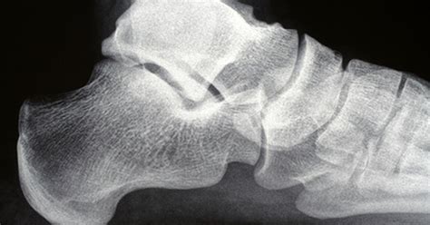 O Que é Um Entesófito Calcâneo Plantar Ehow Brasil