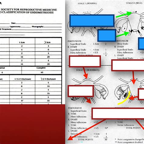 Enzian Classification With Potentially Affected Organs And