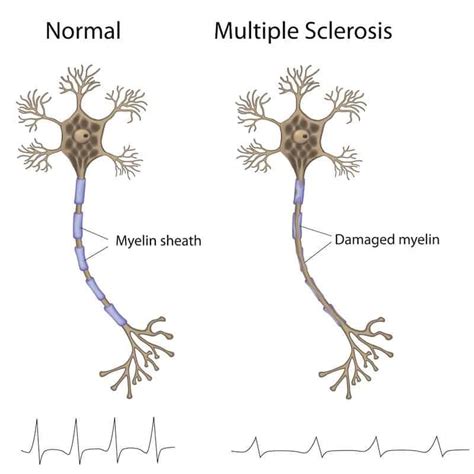 Stem Cell Treatment Offers Hope For Ms Treatment