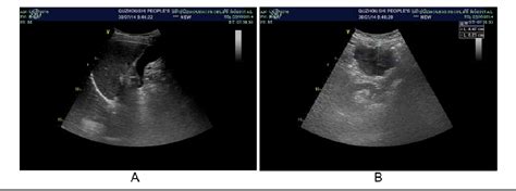 Figure 1 From A Case Of Recurrent Hepatocellular Carcinoma Acquiring Complete Remission Of