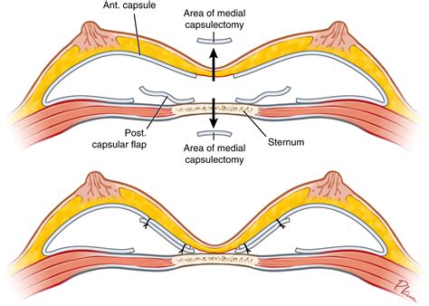 Revision Breast Augmentation—correction Of Implant Malposition And