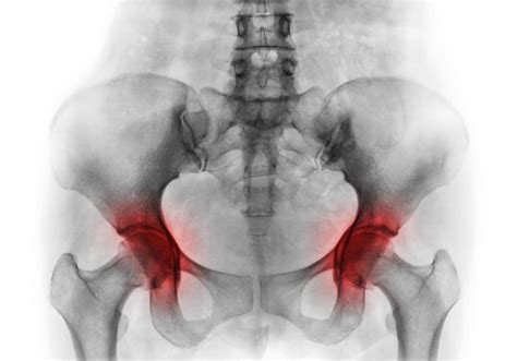 Common Causes Of Female Hip Pain
