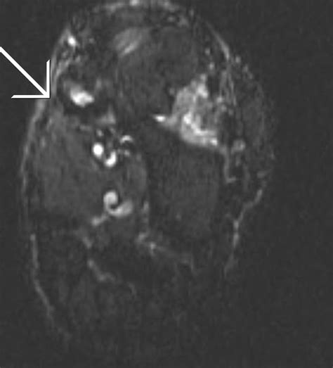 Os Navicularis Syndrome Mri Sumer S Radiology Blog