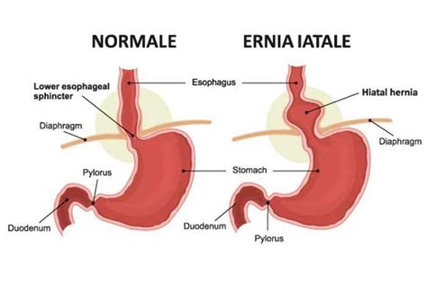 Ernia Iatale E Senso Di Svenimento Flash Sales Emergencydentistry