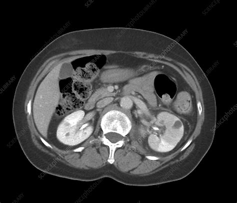 Pyelonephritis Axial Ct Scan Stock Image C047 4756 Science Photo Library
