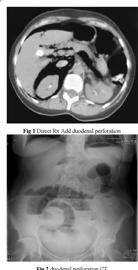 [pdf] Perforated Duodenal Events Post Semantic Scholar