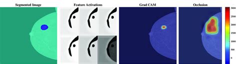 Examples Of Correctly Segmented Mammogram Images Generated By The