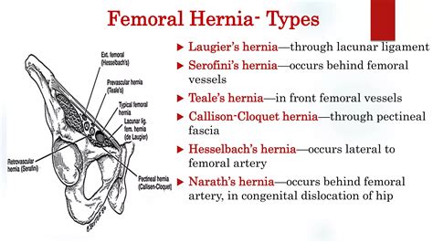 Femoral Hernia Groin Swellings Ppt