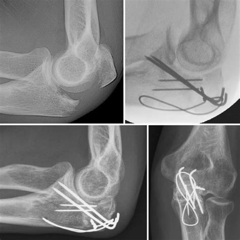 Pdf Fractures Of The Olecranon Radial Head Neck And Coronoid Process