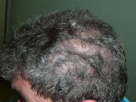 Congenital Nevus Scalp