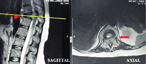 Magnetic Resonance Imaging Mri Of The Patients Spine Arrowhead